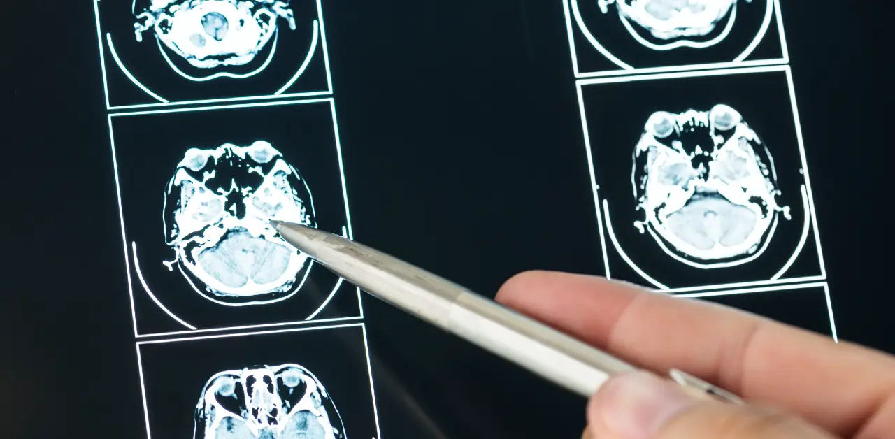 Na hersenschudding MRI gedaan, maar toch nog klachten? | ABC